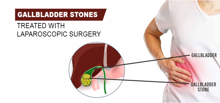 Laparoscopic Surgery For Gallbladder Stone Removal in Amritsar